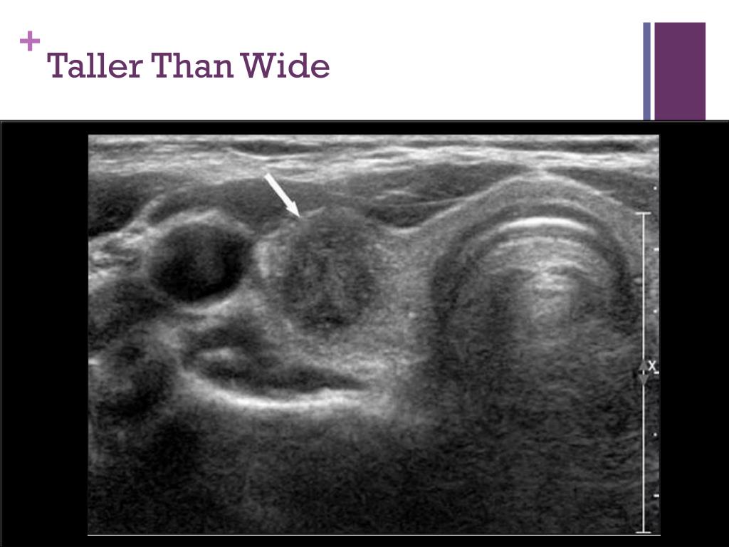PPT - Thyroid Nodules and Cancer PowerPoint Presentation, free download ... PPT - Thyroid Nodules and Cancer PowerPoint Presentation, free download ...