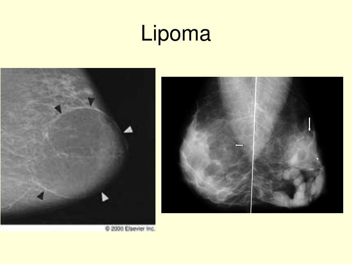 PPT - Mammography 2 PowerPoint Presentation - ID:4110986