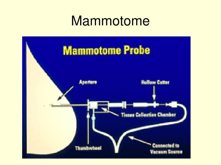 Ppt Mammography 2 Powerpoint Presentation Id 4110986