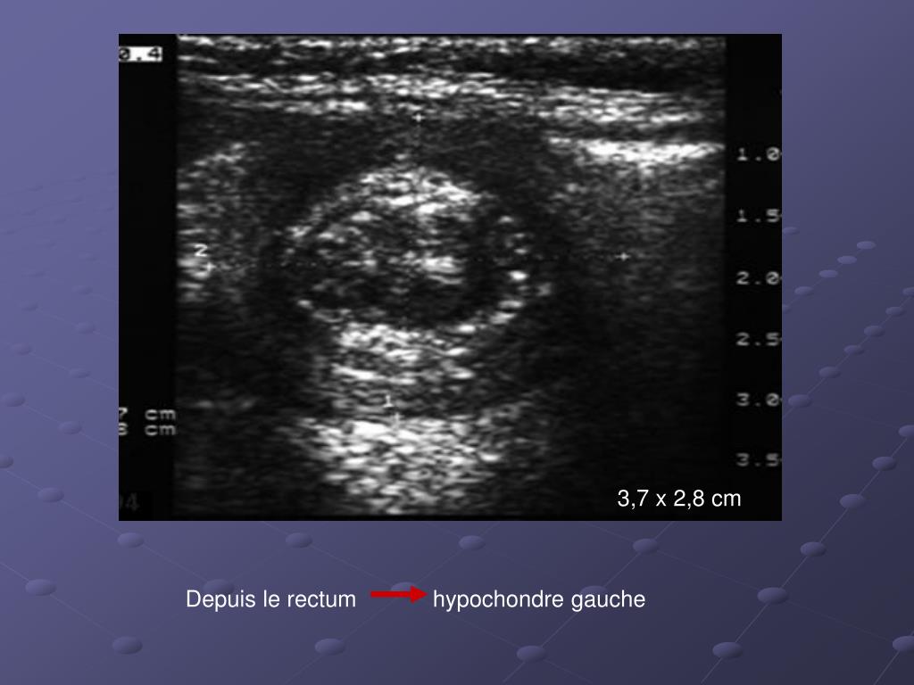 PPT - IMAGERIE DE L’OCCLUSION DIGESTIVE CHEZ L’ENFANT PowerPoint ...