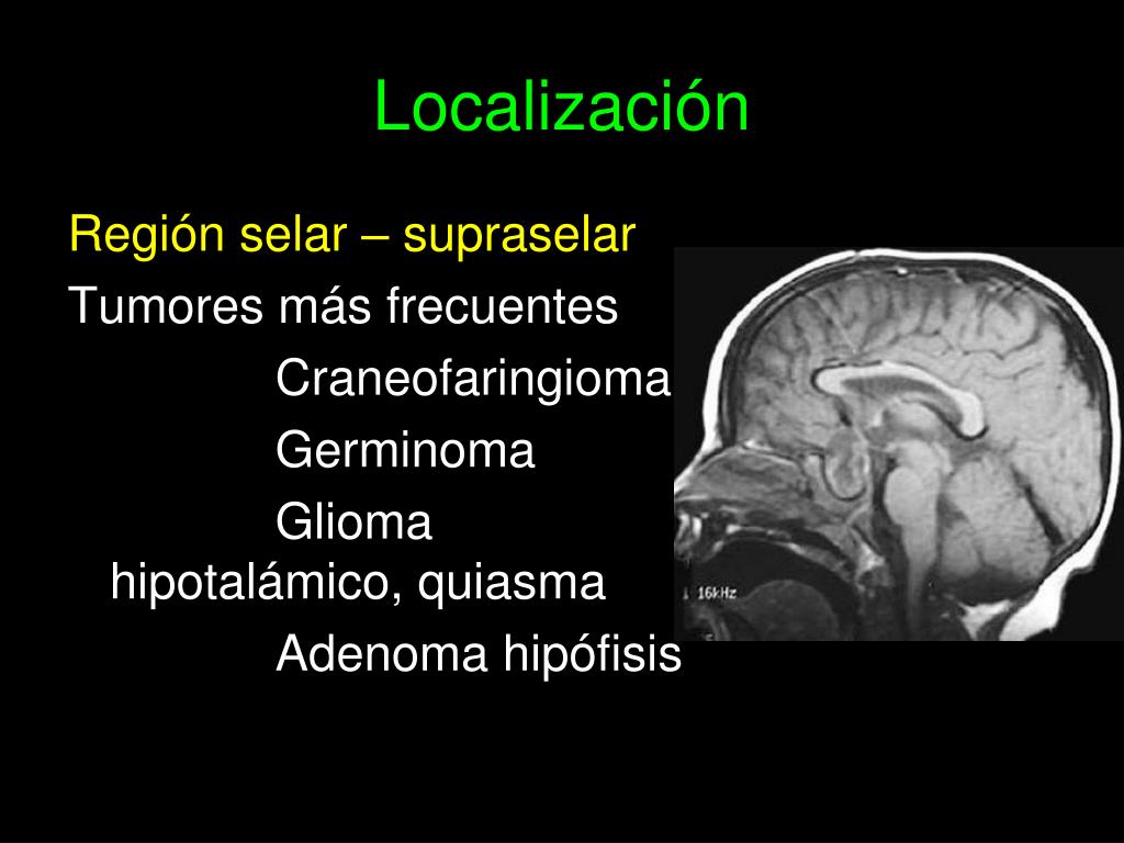 PPT - Tumores de Sistema Nervioso Central Dr. Alejandro Cáceres ...