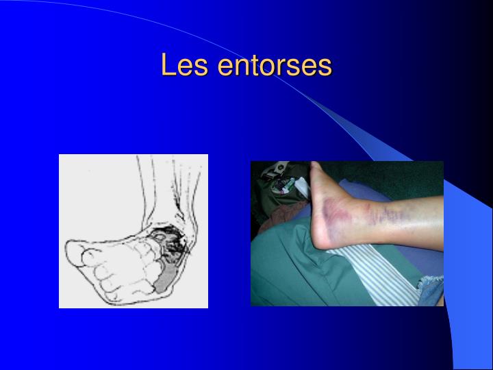 PPT - Généralités en traumatologie PowerPoint Presentation - ID:4119803