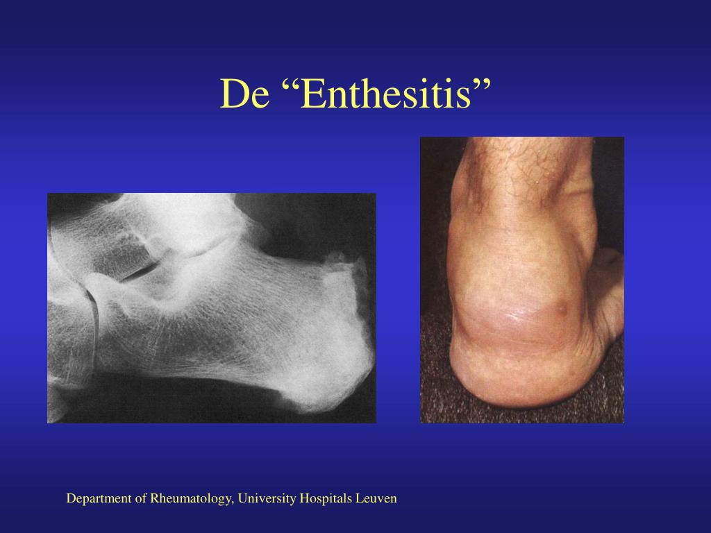 PPT - Chronische Artritis : van Symptoomverlichting naar Functioneel ...