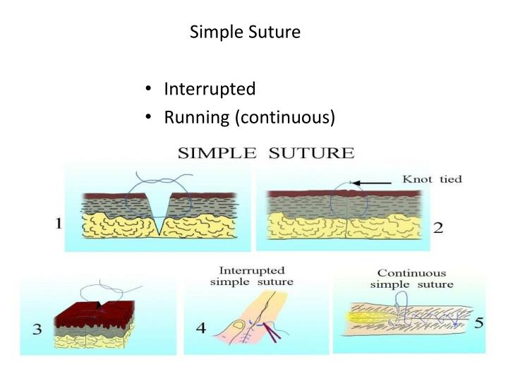 PPT - Suture, Needles, Staplers, Wound Closure Techniques, & Wound ...