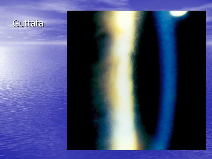 PPT - Corneal Dystrophies and Degenerations PowerPoint Presentation ...