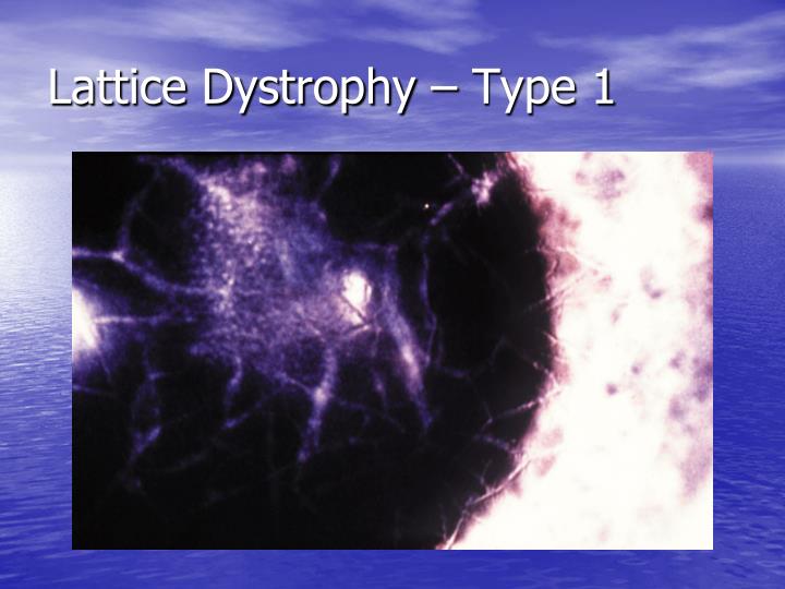 PPT - Corneal Dystrophies and Degenerations PowerPoint Presentation ...
