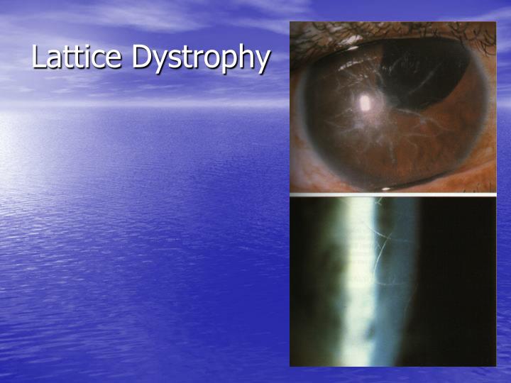 PPT - Corneal Dystrophies and Degenerations PowerPoint Presentation ...