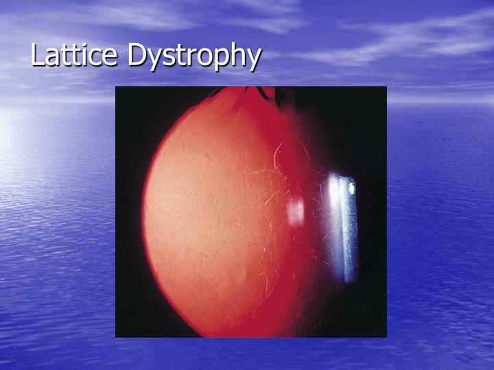 PPT - Corneal Dystrophies and Degenerations PowerPoint Presentation ...