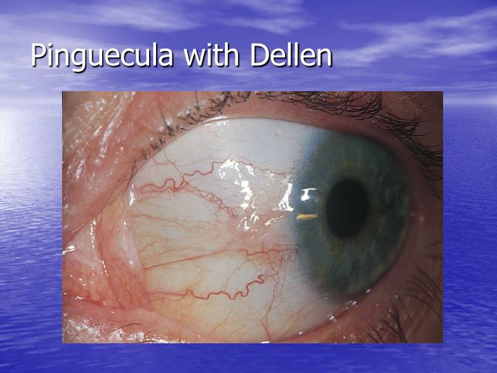 PPT - Corneal Dystrophies and Degenerations PowerPoint Presentation ...