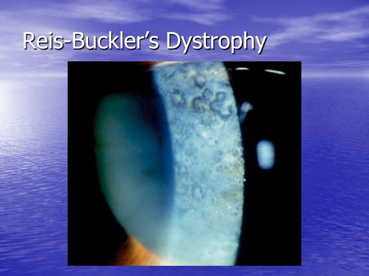 PPT - Corneal Dystrophies and Degenerations PowerPoint Presentation ...