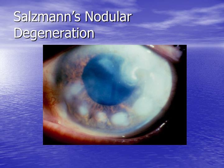 PPT - Corneal Dystrophies and Degenerations PowerPoint Presentation ...