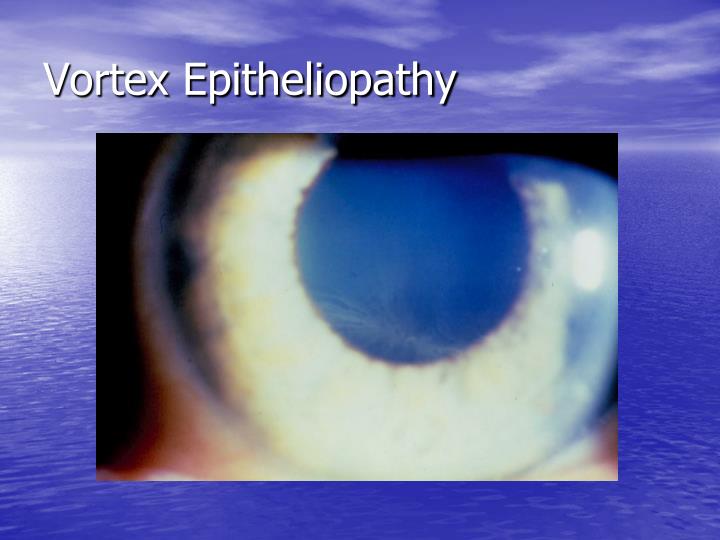 PPT - Corneal Dystrophies and Degenerations PowerPoint Presentation ...