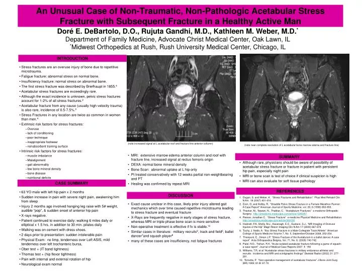 PPT - Stress fractures are an overuse injury of bone due to repetitive ...