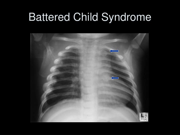 PPT - Trauma PowerPoint Presentation - ID:4133840