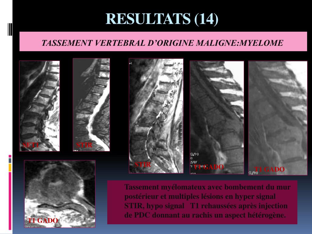 PPT - APPORT DE L’IRM DANS LE DIAGNOSTIC ETIOLOGIQUE DES FRACTURES ...
