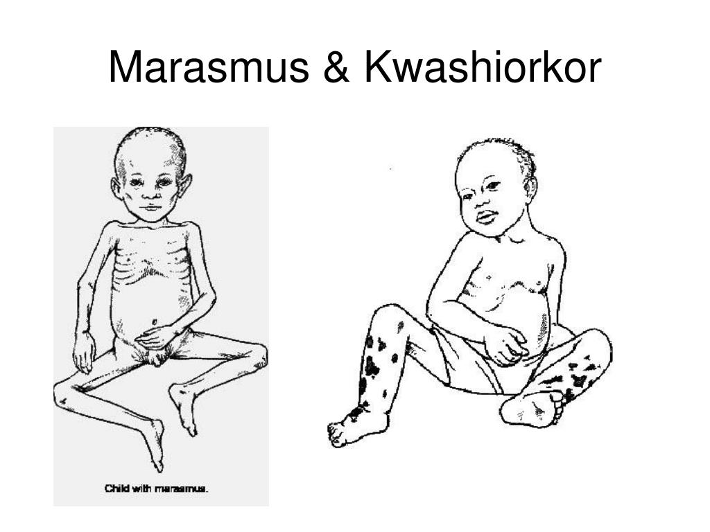 PPT - Food Supply and Malnutrition PowerPoint Presentation, free ...