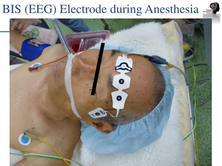 PPT - ･ General Anesthesia ・ Anesthesia and EEG ・ Mechanism of ...