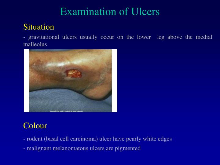 PPT - VENOUS DISEASE & CHRONIC VENOUS INSUFFICIENCY PowerPoint ...