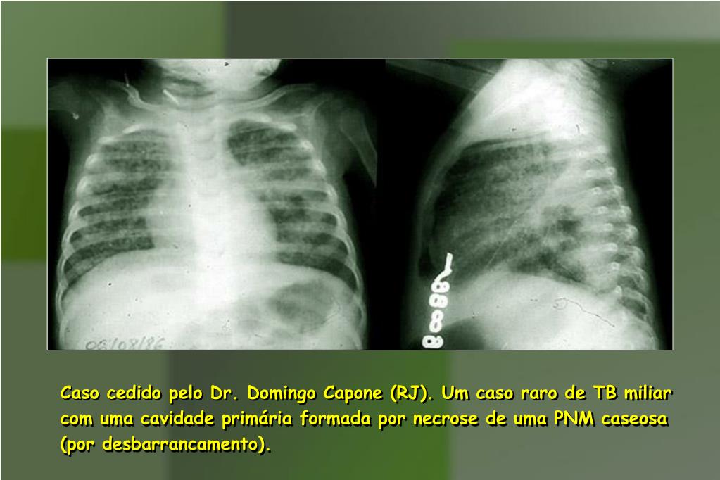 PPT - A patogenia das imagens na tuberculose pulmonar PowerPoint ...