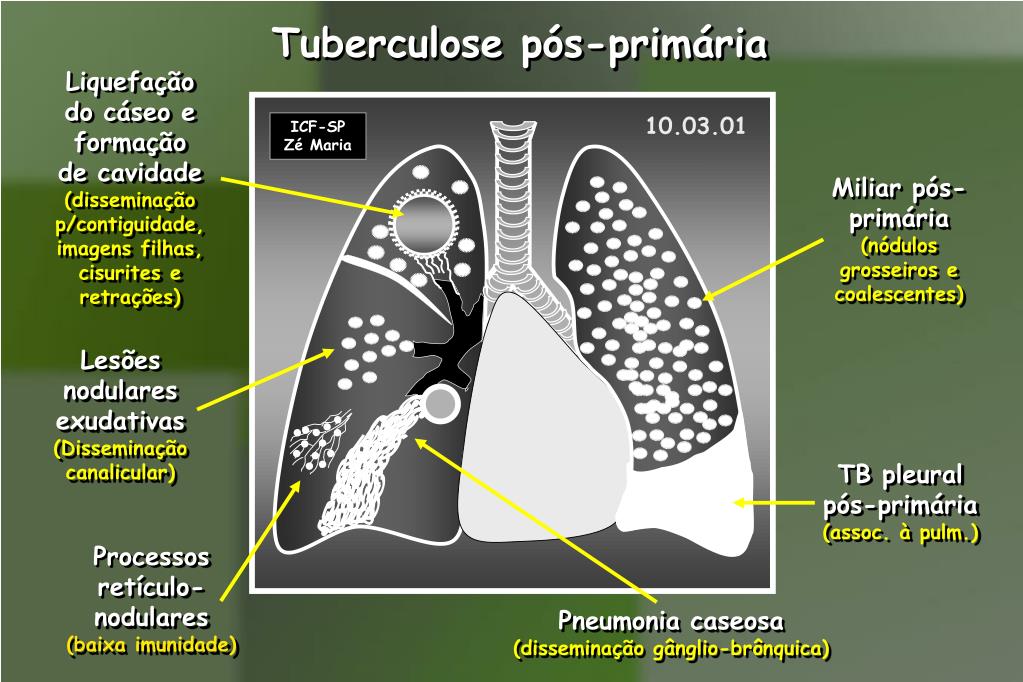 PPT - A patogenia das imagens na tuberculose pulmonar PowerPoint ...