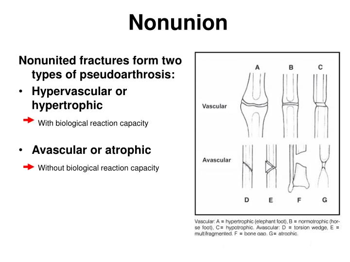 PPT - Nonunion PowerPoint Presentation - ID:4154618
