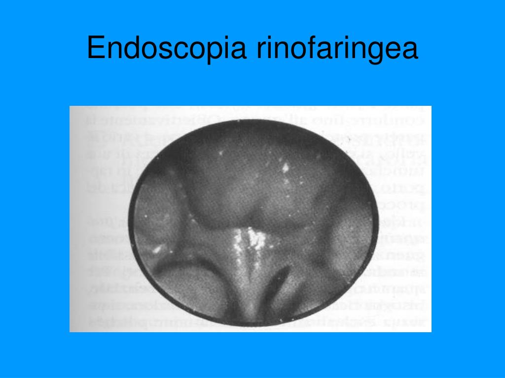 PPT - Vegetazioni adenoidi e ripercussioni sull’udito PowerPoint ...