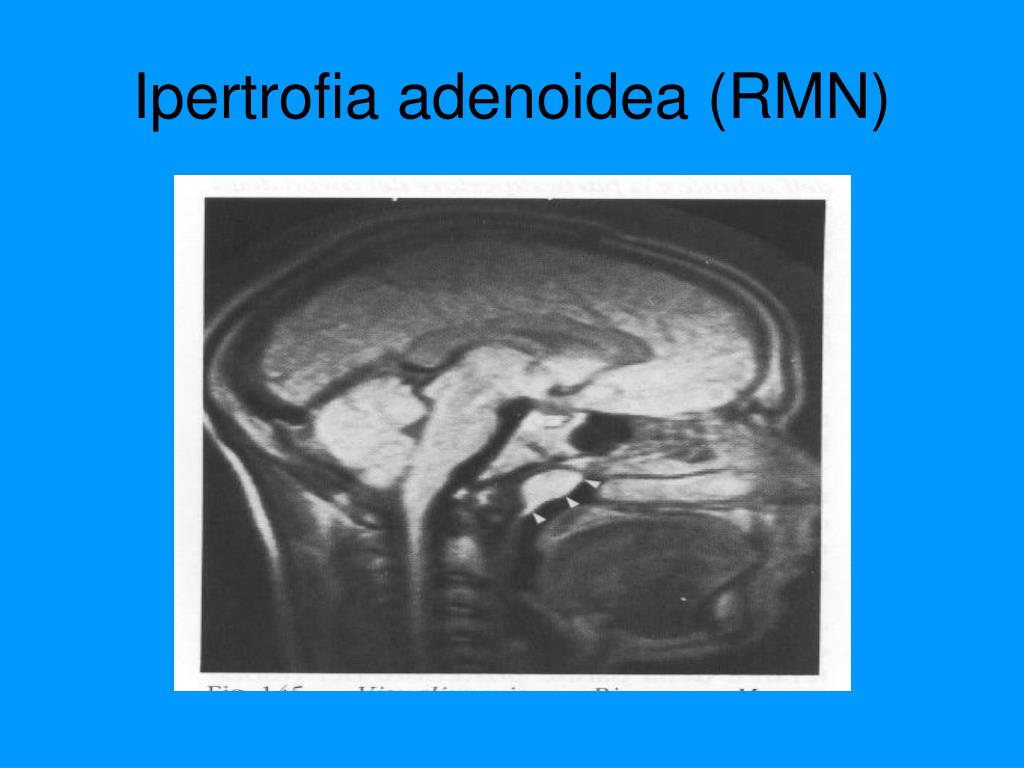 PPT - Vegetazioni adenoidi e ripercussioni sull’udito PowerPoint ...