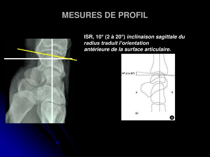 PPT - ANATOMIE RADIOLOGIQUE DU POIGNET PowerPoint Presentation - ID:4163559