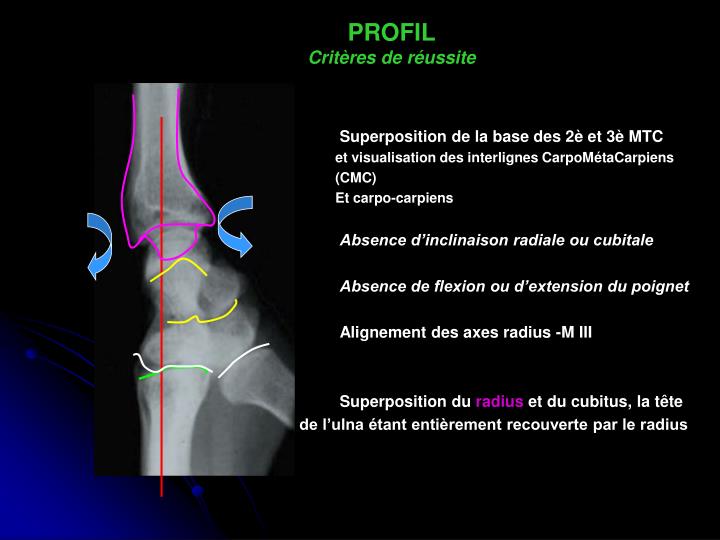 PPT - ANATOMIE RADIOLOGIQUE DU POIGNET PowerPoint Presentation - ID:4163559