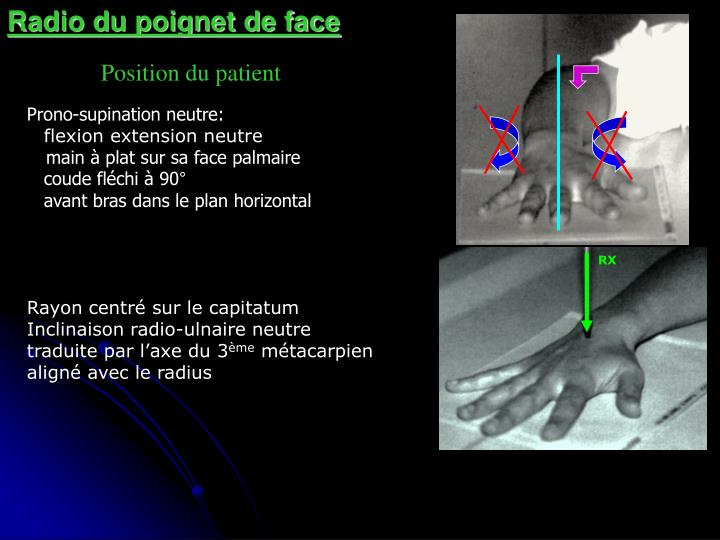 PPT - ANATOMIE RADIOLOGIQUE DU POIGNET PowerPoint Presentation - ID:4163559