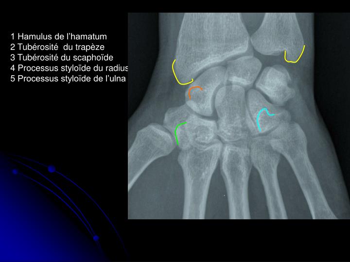 PPT - ANATOMIE RADIOLOGIQUE DU POIGNET PowerPoint Presentation - ID:4163559
