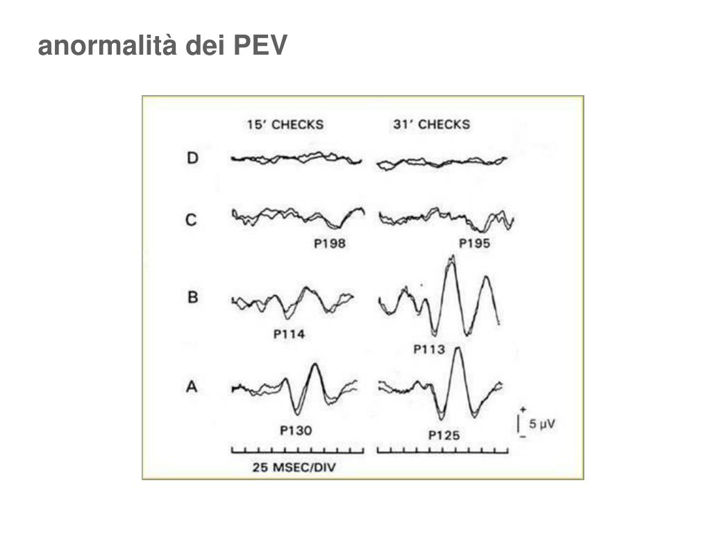 PPT - Potenziali Evocati Visivi (PEV) PowerPoint Presentation, free ...
