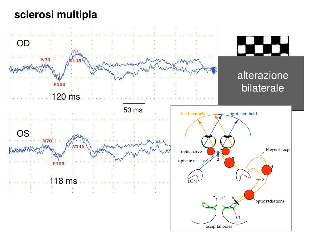 PPT - Potenziali Evocati Visivi (PEV) PowerPoint Presentation, free ...