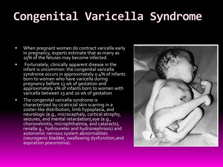 PPT - Varicella -zoster virus PowerPoint Presentation - ID:4168209