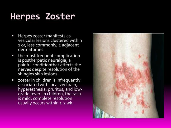 PPT - Varicella -zoster virus PowerPoint Presentation - ID:4168209