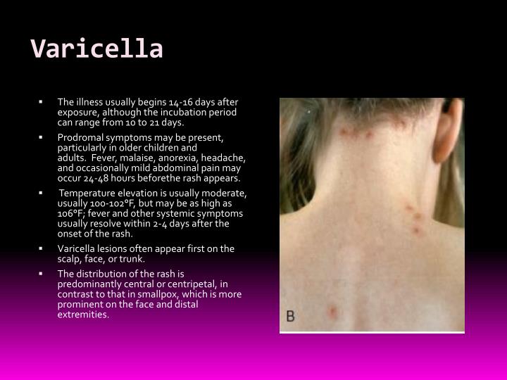 PPT - Varicella -zoster virus PowerPoint Presentation - ID:4168209