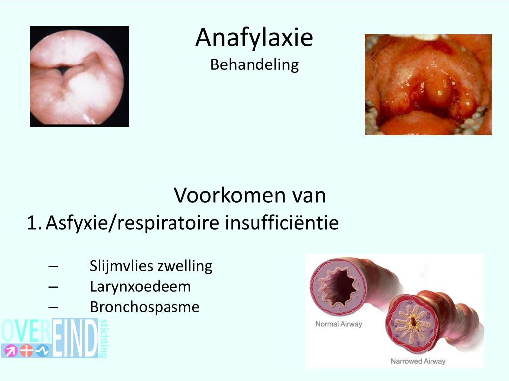 PPT - Anafylaxie en gezwollen lippen, ook adrenaline voor de huisarts ...