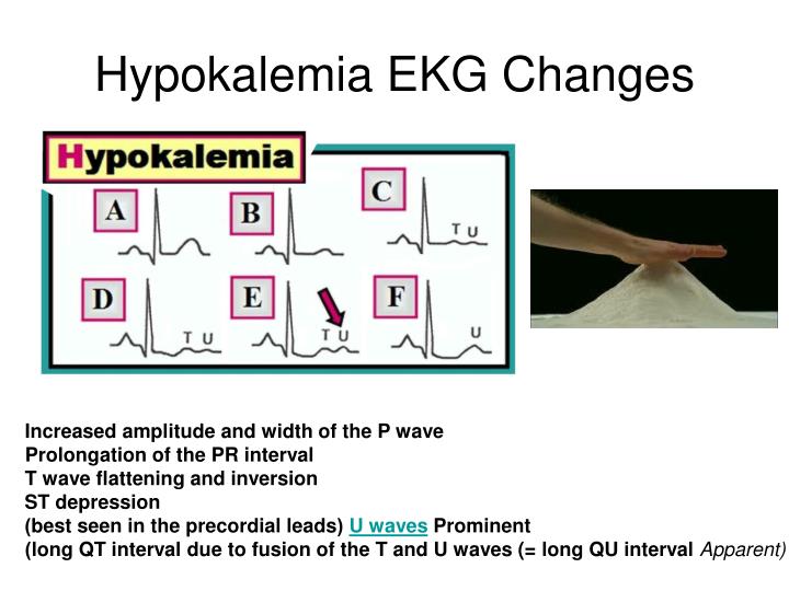 PPT - Hyperkalemia and Hypokalemia PowerPoint Presentation - ID:4175522