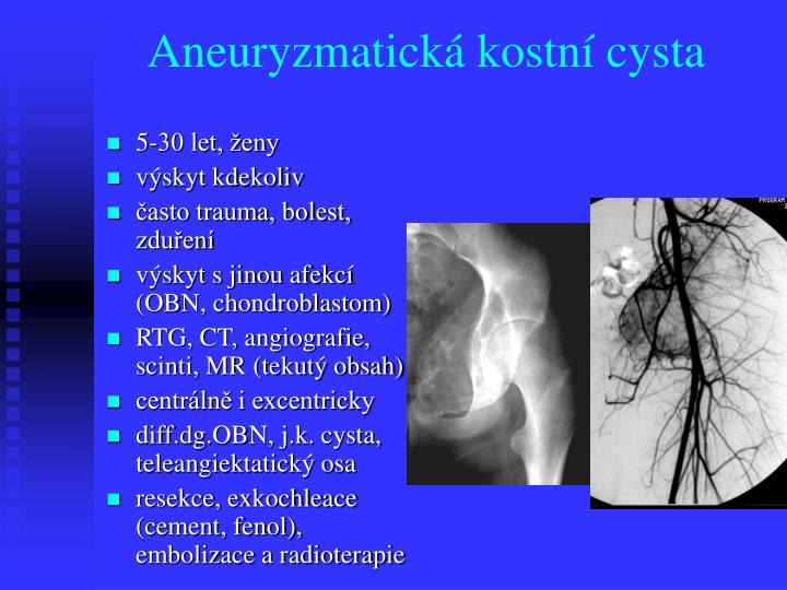 PPT - Benigní kostní nádory a afekce PowerPoint Presentation - ID:4181870