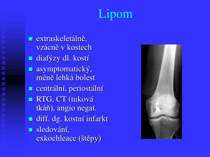 PPT - Benigní kostní nádory a afekce PowerPoint Presentation - ID:4181870