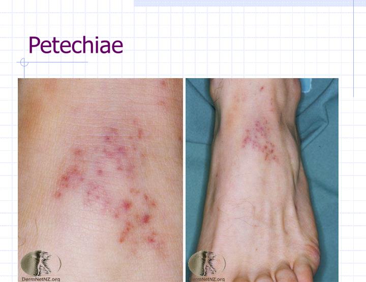 PPT - CUTANEOUS MEDICINE PART 3 PowerPoint Presentation - ID:4188630