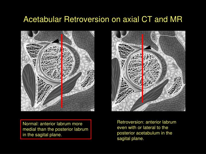PPT - Femoroacetabular Impingement: FAI PowerPoint Presentation - ID ...