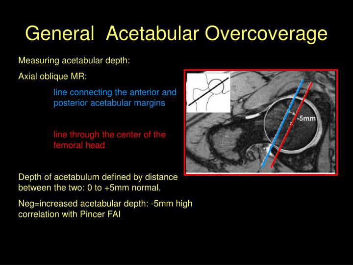 PPT - Femoroacetabular Impingement: FAI PowerPoint Presentation - ID ...