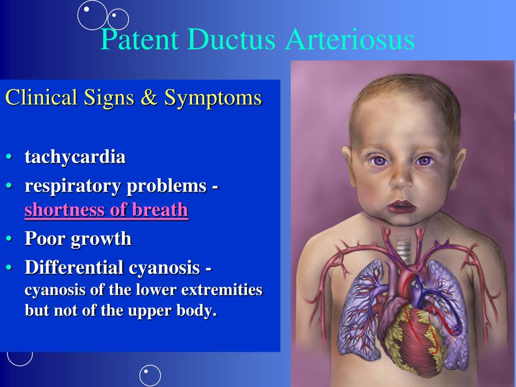 Patent Ductus Arteriosus Signs And Symptoms