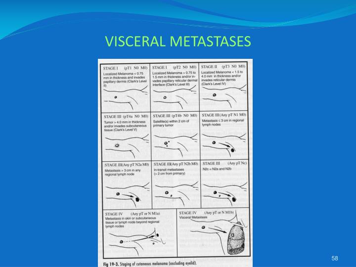 PPT - CUTANEOUS MELANOMA PowerPoint Presentation - ID:4203879