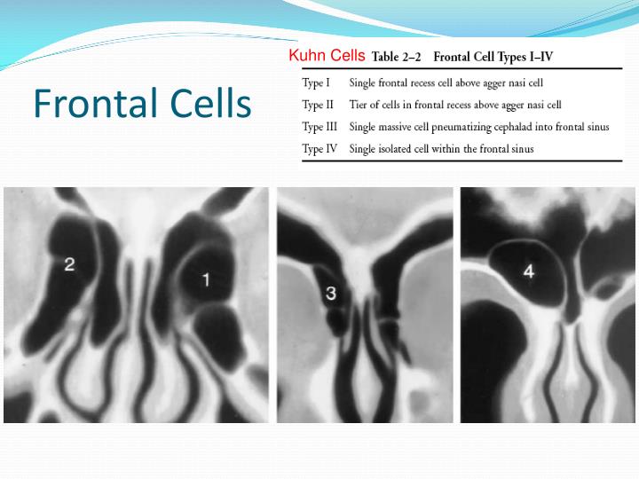 PPT - Principles of Functional Endoscopic Sinus Surgery PowerPoint ...