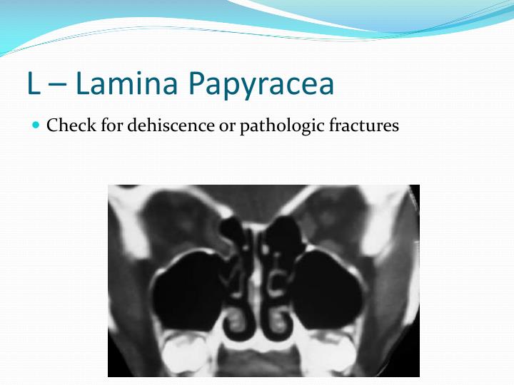 PPT - Principles of Functional Endoscopic Sinus Surgery PowerPoint ...