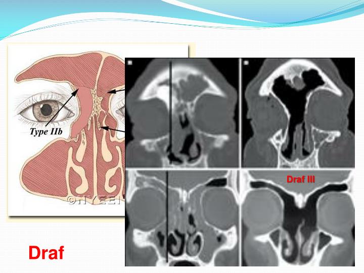 PPT - Principles of Functional Endoscopic Sinus Surgery PowerPoint ...