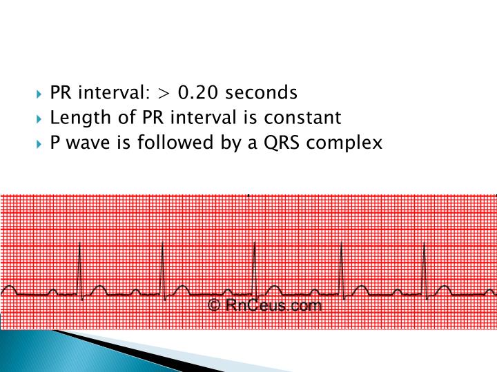 PPT - Heart Block PowerPoint Presentation - ID:4214307
