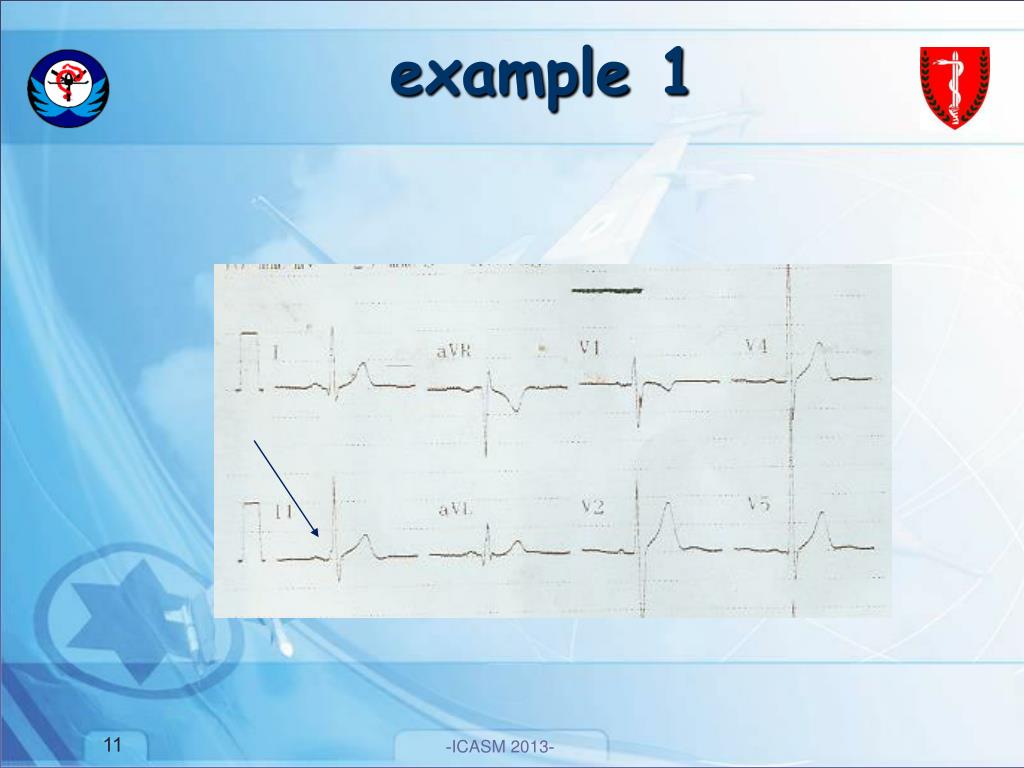 PPT - Pre-participation ECG screening in military recruits- the IDF ...